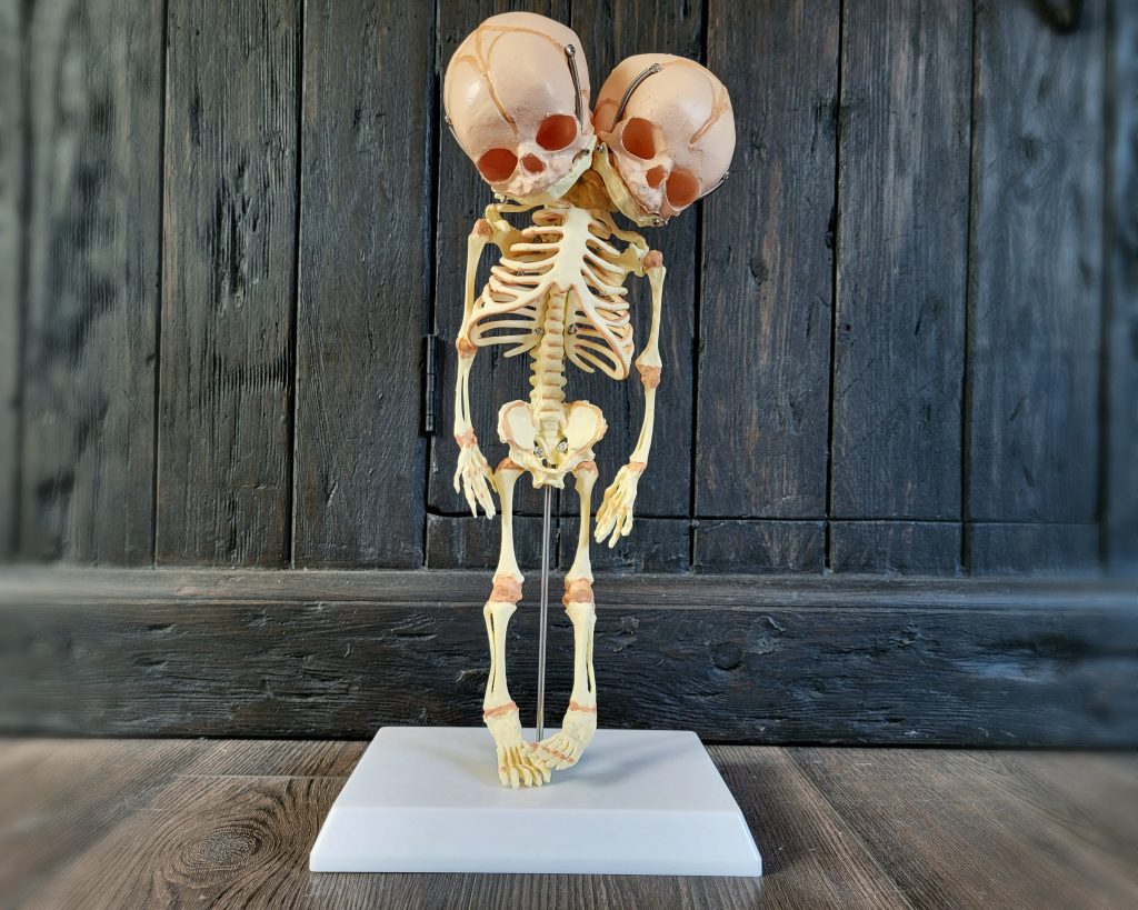 2 Headed Fetal Skeleton, Human Fetus Skeleton, Conjoined Twins Skeleton ...